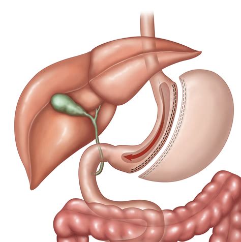 Diet After Gastric Bypass Tips Weight Loss Surgery