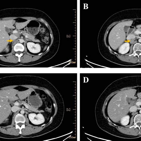 Lymph Nodes Recurrent Between The Aorta And Inferior Caval Vein A And