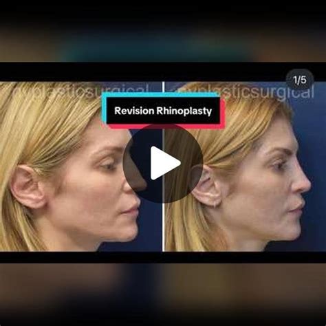 Dr Richard Reish Before And After Rrhinoplastycommunity