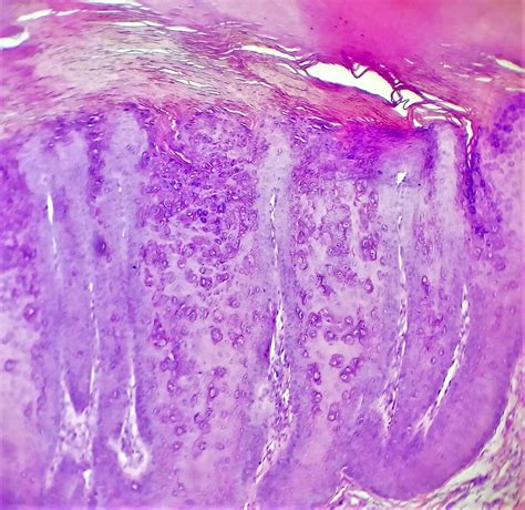 Verruca Plana Histopathology Verrucous Plaques On Sun Exposed Areas
