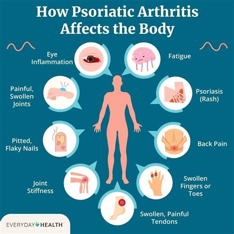 Psoriatic Arthritis Arthurcare