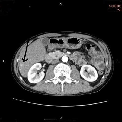 Figure 2 From Combined Hepatocellular Cholangiocarcinoma With Stem Cell Features Ductal Plate