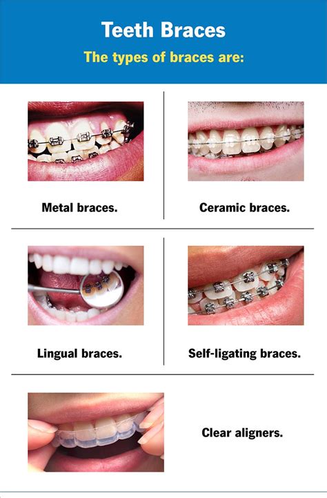 How Braces Work Braces Apply Gentle I Love Cebu Braces Facebook