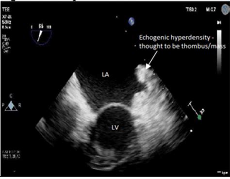Intra Operative Tee Showing Echogenic Hyper Density In The Left Atrial