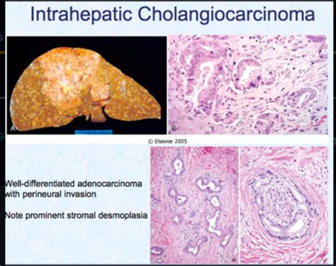 Hepatobiliary Parasites Flashcards Quizlet