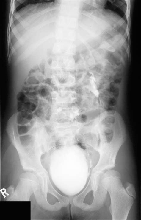 Crossed Fused Renal Ectopia Pacs