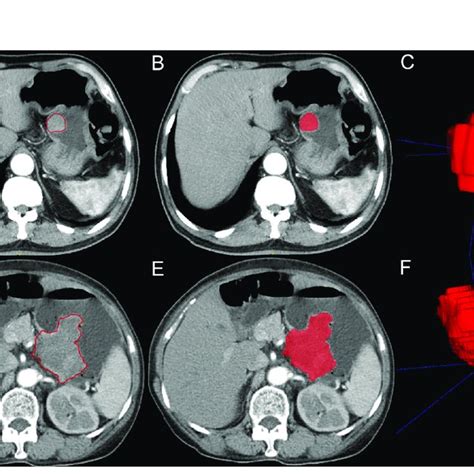 Imaging Segmentation Of Gastrointestinal Stromal Tumors Gist On Download Scientific Diagram
