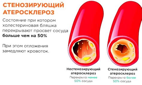 Холестериновые бляшки они навсегда? Воспользуйтесь 8 советами, для ...