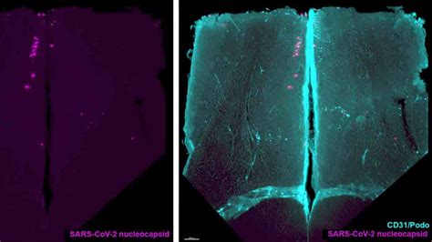 Sars Cov 2 Virus Spreads Within Neurons