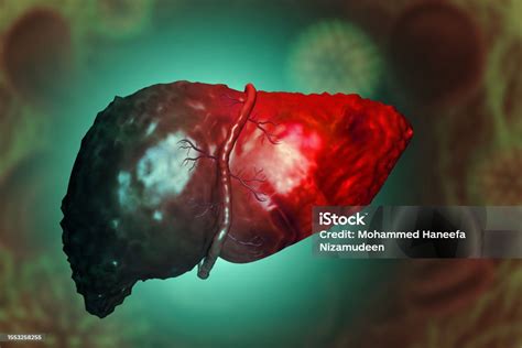 지방간 섬유증 간경변 및 간암과 같은 간 손상 3d 일러스트레이션 간암에 대한 스톡 사진 및 기타 이미지 간암 3차원 형태
