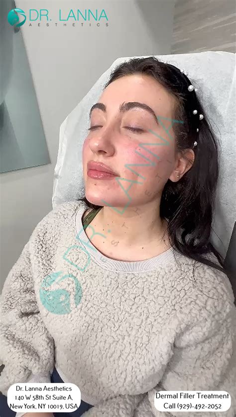 Dissolving Cheek Filler Before And After Results Doctor Lanna