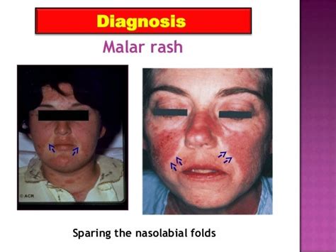 Lupus Nephritis Post Fff