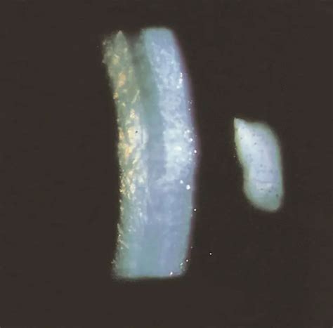 Fuchs Endothelial Corneal Dystrophy American Academy Of Ophthalmology