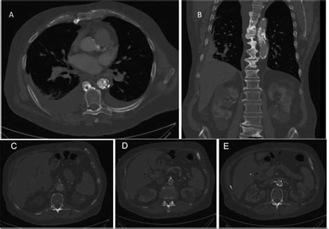 Society For Vascular Surgery On Linkedin Extra Anatomic Bypass Can Treat Renovascular