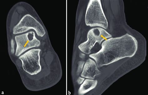 Ct Examination Revealed A Large Cyst Lesion Over Medial Talar Dome Download Scientific Diagram