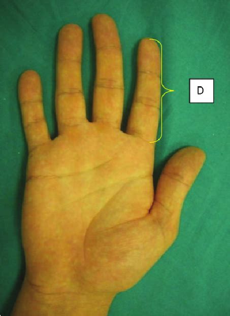 Measurement Of Digit Length Download Scientific Diagram