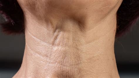 Neck Mass Symptoms Diagnosis And Treatment Semg