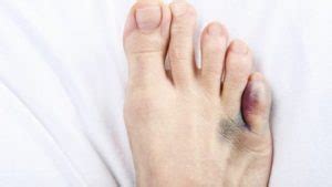 Recognizing And Managing Jammed Toe Symptoms