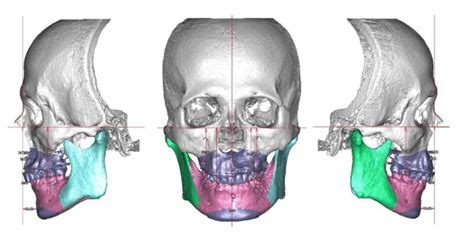 The Pre Surgical 3d Composite Craniofacial Model Download Scientific
