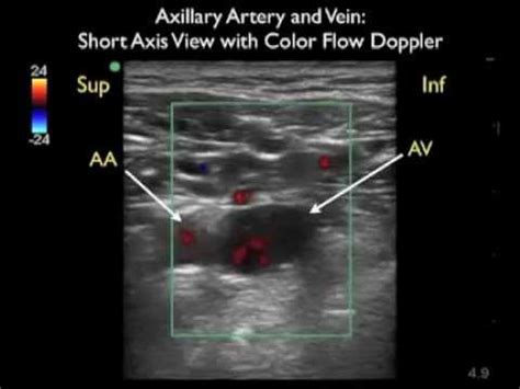 How To Axillary Vein Cannulation Sonosite Ultrasound Mp4 Youtube