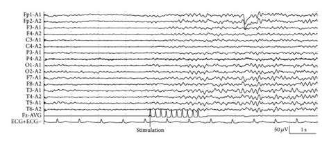 Eeg R To Quantifiable Electrical Stimulation In Comatose Patients A Download Scientific