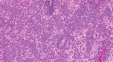 Primary Cns Diffuse Large B Cell Lymphoma Ottawa Atlas Of Pathology