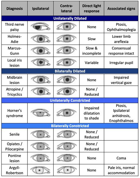 Pupillary Abnormalities Emcyclopedia