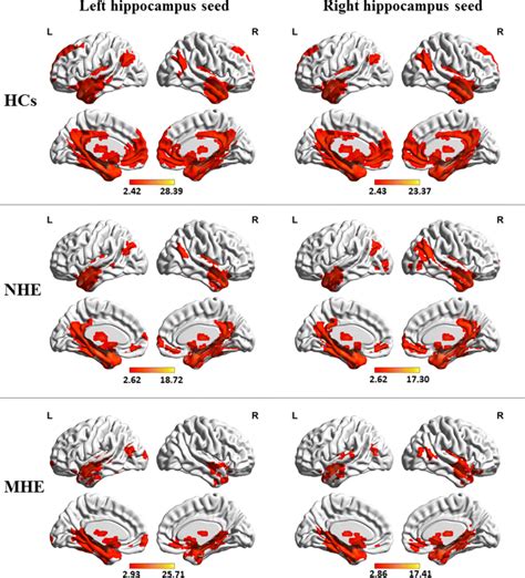 The Pattern Of Hippocampal Functional Connectivity Among The Three Download Scientific Diagram