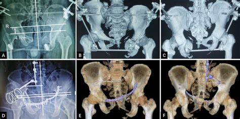 A 32 Year Old Male Patient Treated With The Pronesupine Sequence A