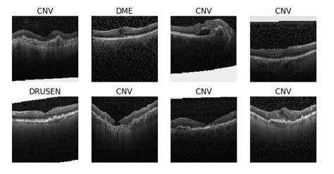 GitHub AnilpreetSingh OCT Classification Diabetic Macular Edema Is The Major Cause Of Vision