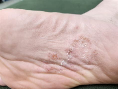 발바닥 피부질환 지식in