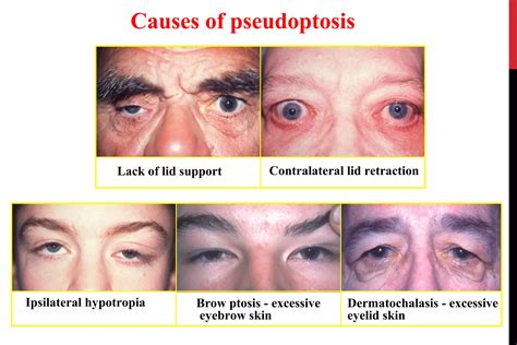 Ptosis Ppt