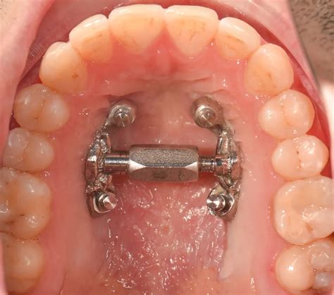 Marpe Expansión Palatina Rápida Asistida Por Microimplantes