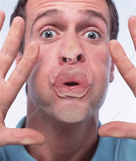 Squashed Face Of A Man Stock Image F0012172 Science Photo Library Squashed Face Of A Man Stock Image F0012172 Science Photo Library