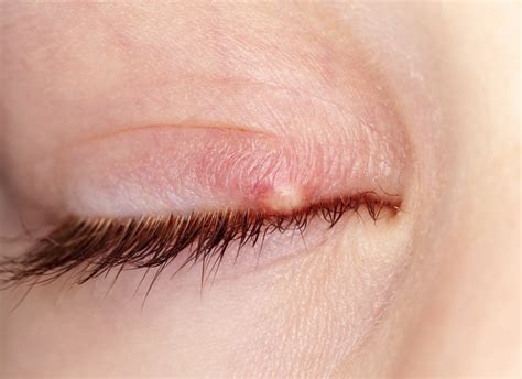 Blepharitis Balmonds