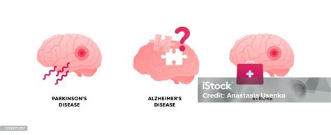 뇌 질환 개념 벡터 플랫 일러스트 세트입니다 파킨슨 알츠하이머 및 뇌졸중 공격 질병 아이콘 건강 관리 신경학 의료 표지판 디자인 요소입니다 파킨슨병에 대한 스톡 벡터 아트