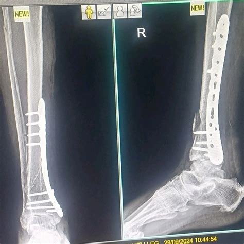 59 Year Female With Fracture Distal Tibia Fixed With Minimally Invasive Dista Tibial Plate Dr
