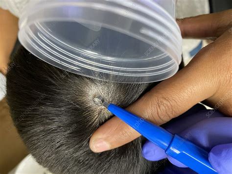 Sampling Ringworm Of The Scalp Stock Image C060 4281 Science Photo Library