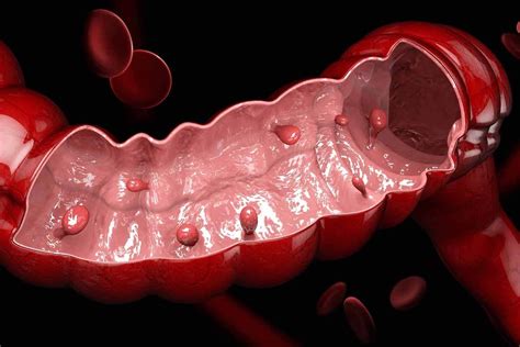 34 Facts About Polyp