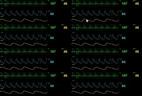 Multi Threaded Drawing Issue Lvgl Lvgl GitHub
