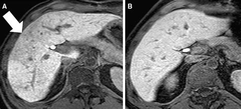 44 Year Old Man With Nodal Metastases From Colon Adenocarcinoma Treated Download Scientific