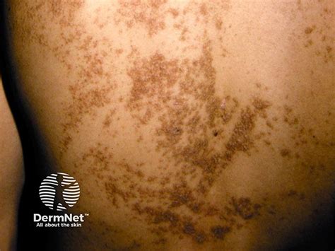Epidermal Naevus Dermnet