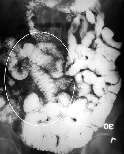 Celiac Stool Appearance