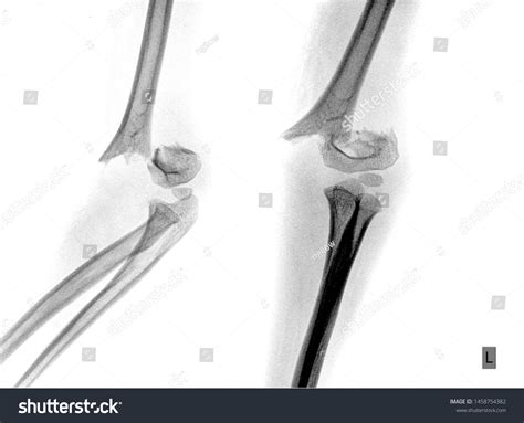 Elbow Anatomy Xray Elbow Anatomy Xray
