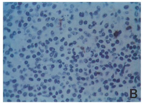 A Flow Cytometry Of Cll Showing Positivity Of The Cells For Both Cd5