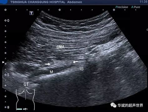 神经超声解剖：臀部坐骨神经