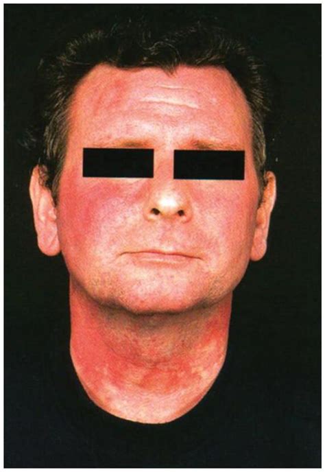 Endocrine Disorders Flushing Multiple Endocrine Neoplasia