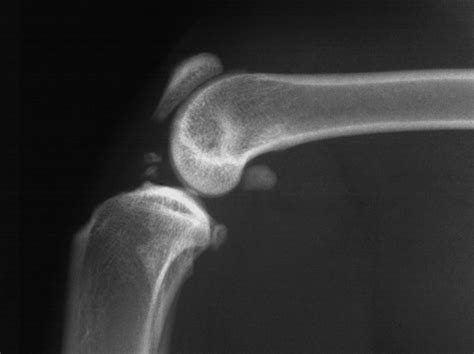 Stifle Meniscal Mineralization In Cats Felis Vetlexicon