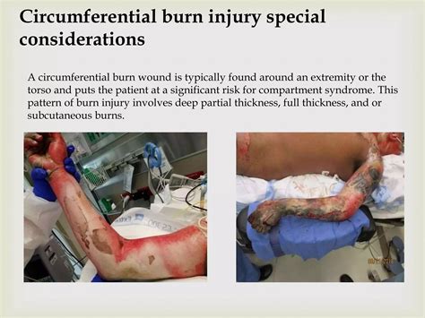Burn Wound Assessment By Priya Malik Mpharm Pptx