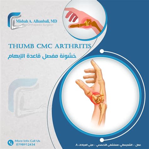 Dr خشونة مفصل قاعدة الإبهام Thumb Cmc Arthritis هي حالة تتسم